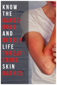 Know the Dangerous and Deadly Life Threatening Skin Rashes ...