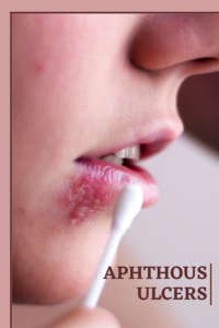 Aphthous Ulcers - Superfoodsliving.com